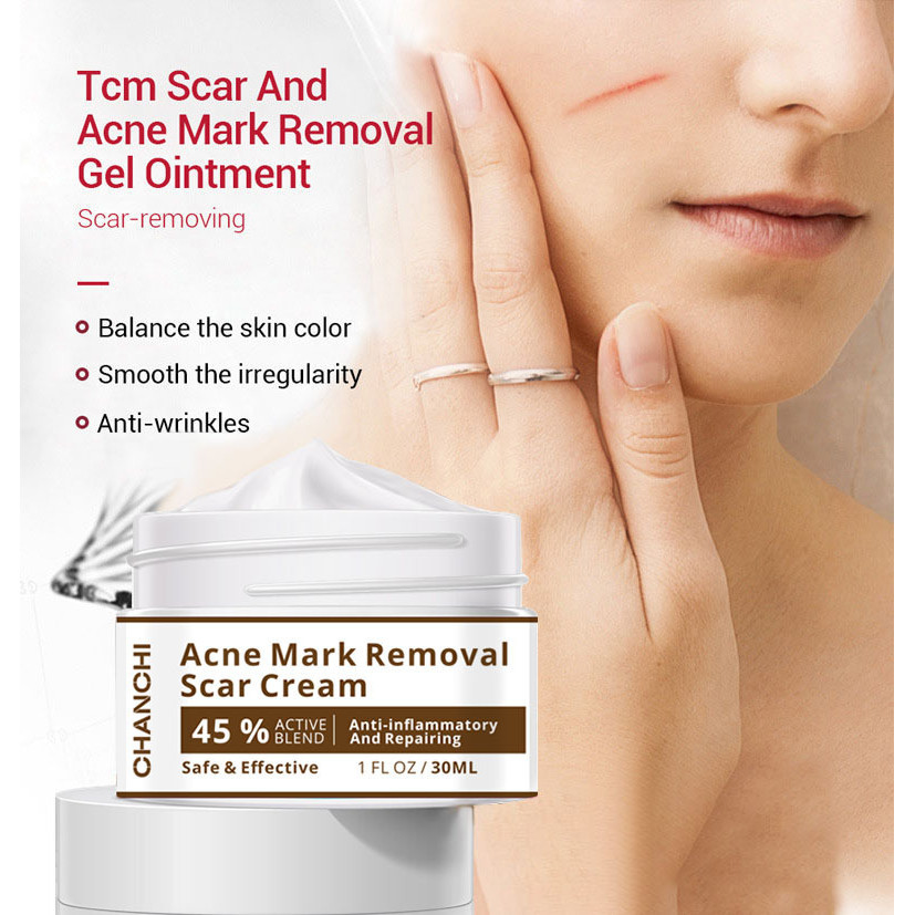 Acne Mark Fade Cream Remove Facial Blemish Remove Mark Remove Acne Mark ...