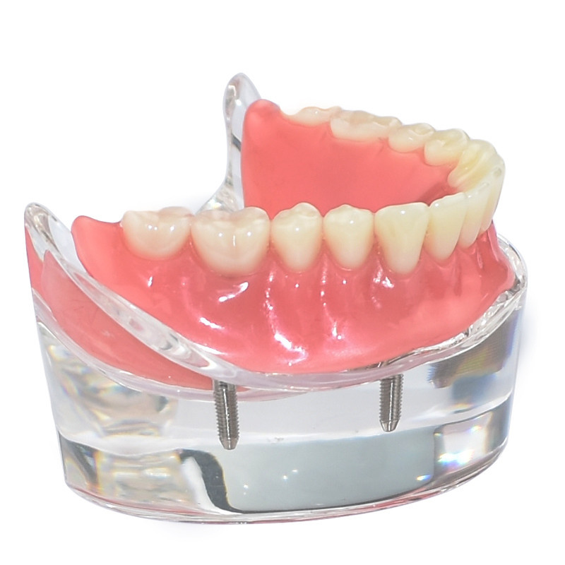 Dental Overdenture Tooth Model Removable Interior Mandibular Lower For ...