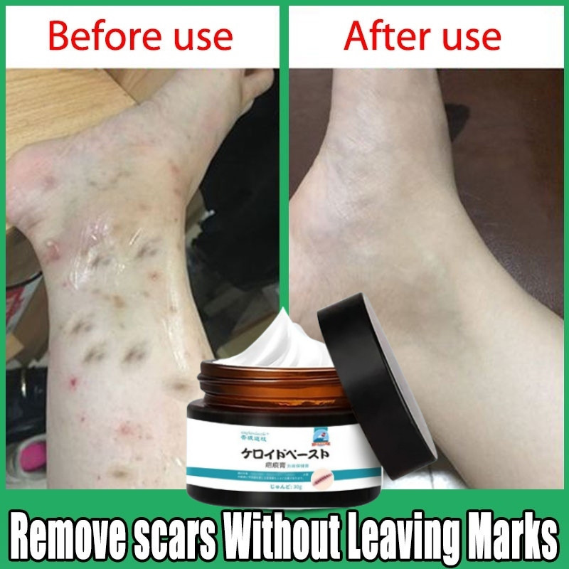 Japan Scar Removal Cream 30g Anzusaka Michie Scar Cream Cream Burn Scar ...
