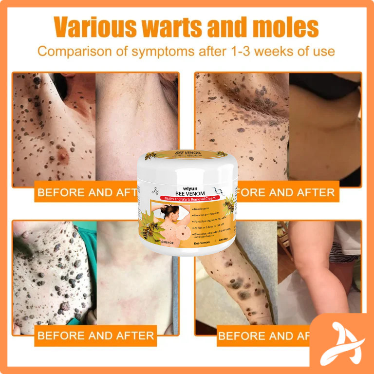 Wart Removal Cream Ubat Ketuat Ubat Kutil Mole Remover Cream Skin Tag ...