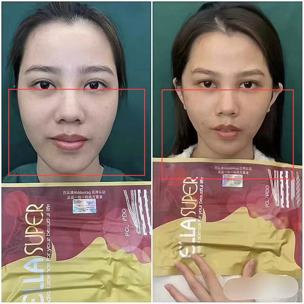 Elle PDO Thread Lift Kit | 20-100 PCS | 10x100mm Cone 4D Cog | Ultimate ...