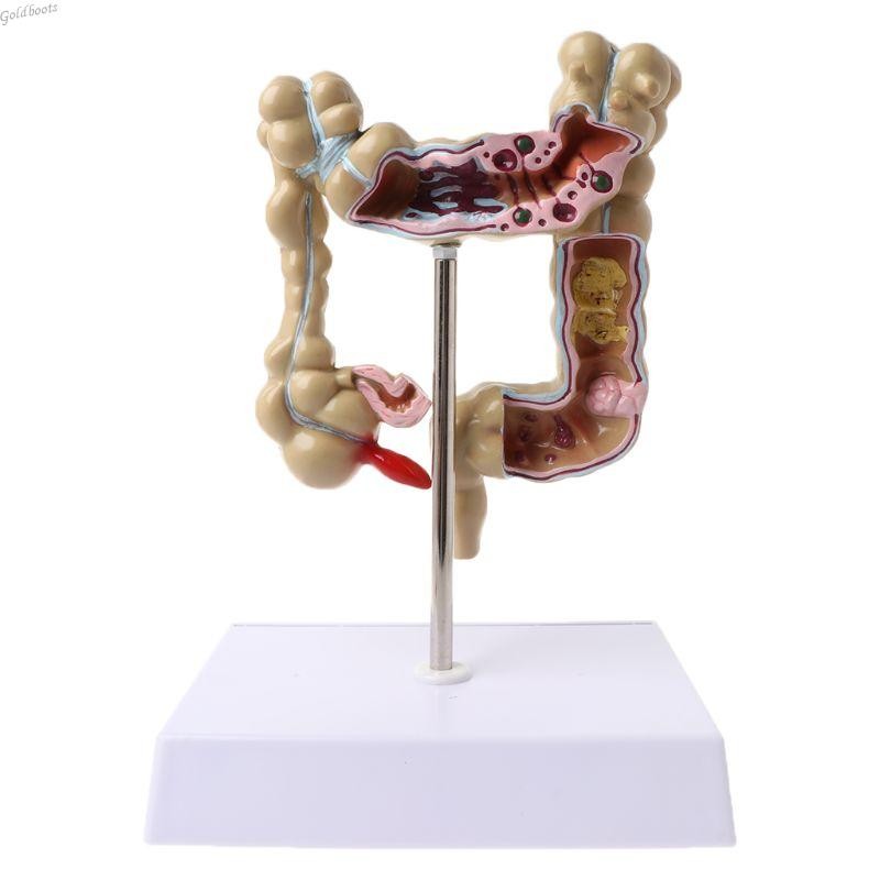 GB Human Colorectal Lesion Model Pathological Anatomy Colon Diseases ...