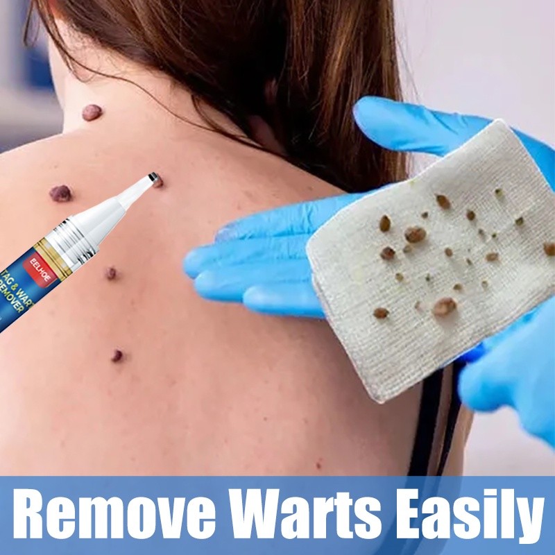 ST2 Warts Remover Original Kasoy Oil Warts Remover Warts And Skin Tags ...