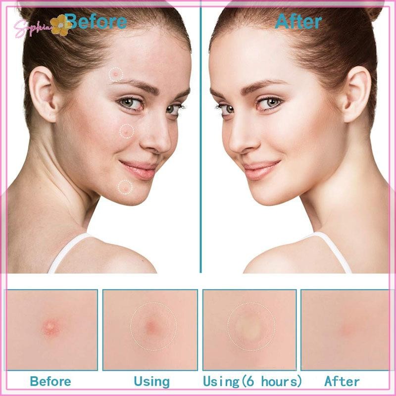 UVIGM> 360pcs Invisible Acne Patches Removal Pimple Anti-Acne Hydrocolloid Patches Spots Marks ...