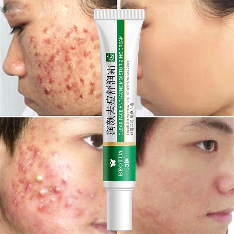 Effective Acne Removal Cream/Oil Control/Skin Care Gel 20g | Shopee ...