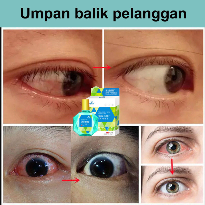MATA MERAH Relieve Fatigue, Dry Eyes, Dry Eye Pain, Red Blood Itching ...