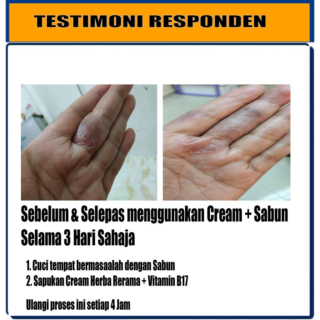 KRIM GATAL DAUN RERAMA - KULIT GATAL [30 GRAM]+ FREE GIFT+FREE SHIPPING ...