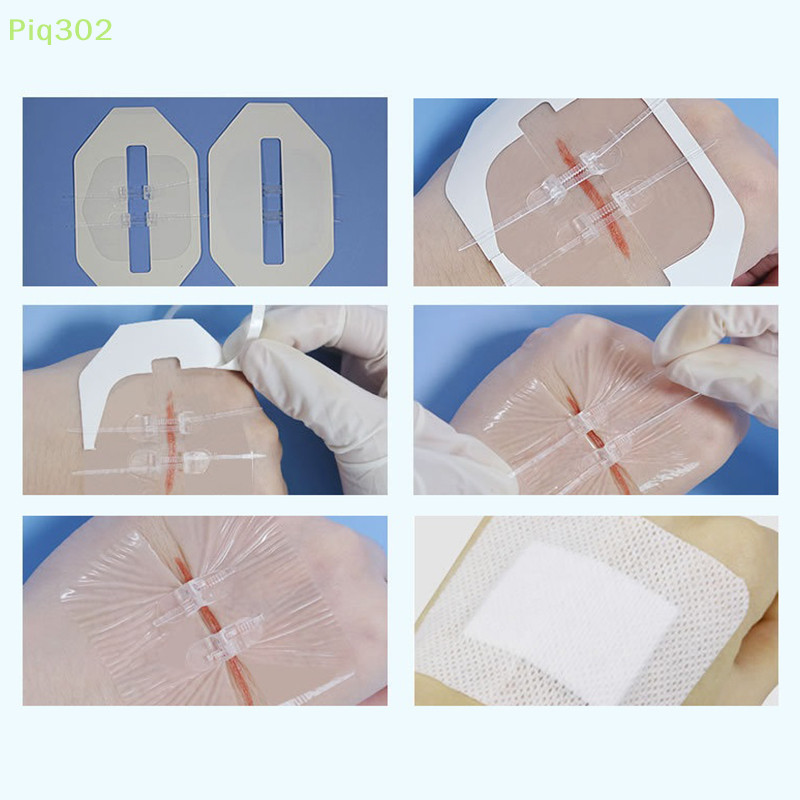 Piq302 1/2Pcs Zipper Band-aid Suture-free Wound Dressing Patches ...