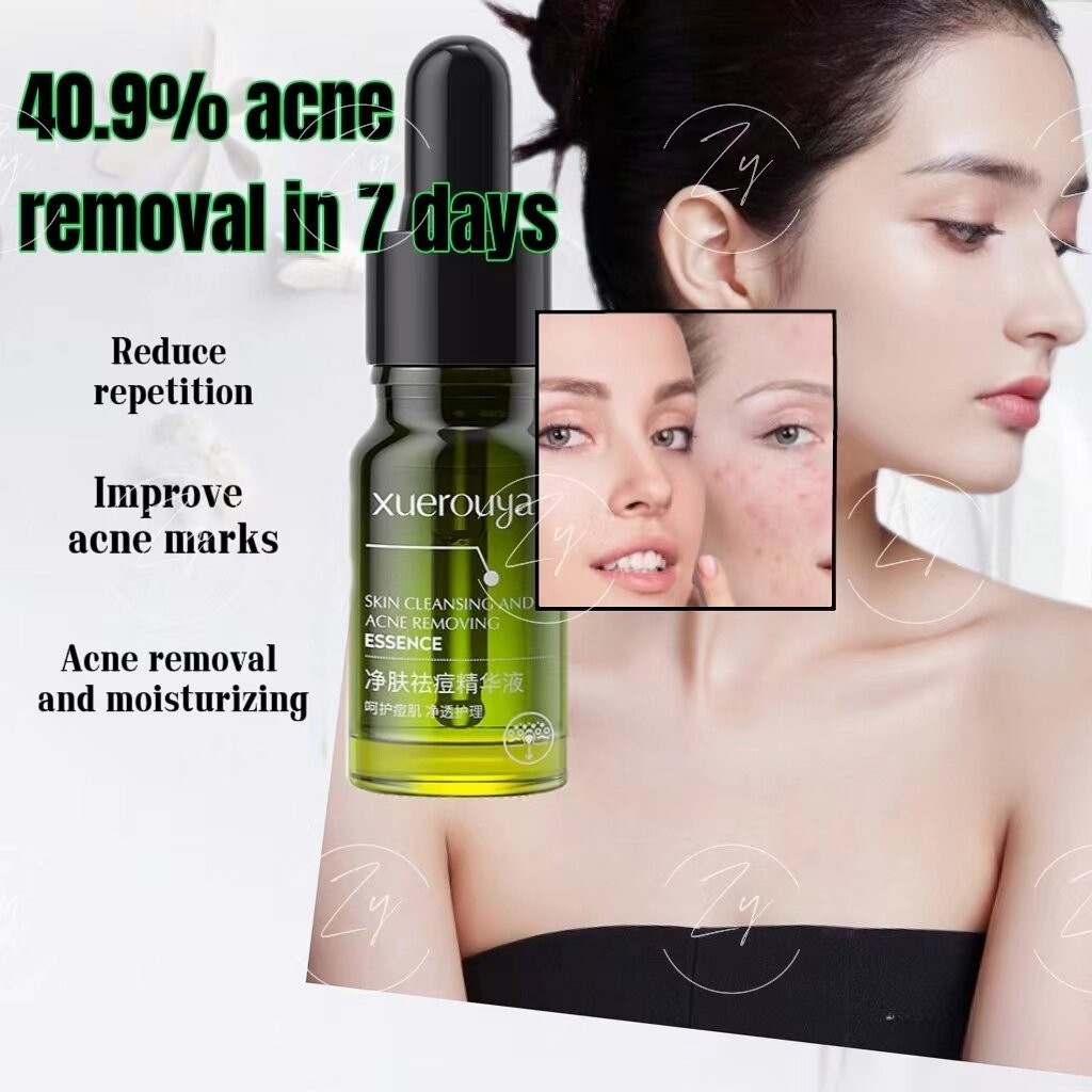 Quickly Remove Acne Marks Lighten Blackheads Shrink Fine Pores Acne ...