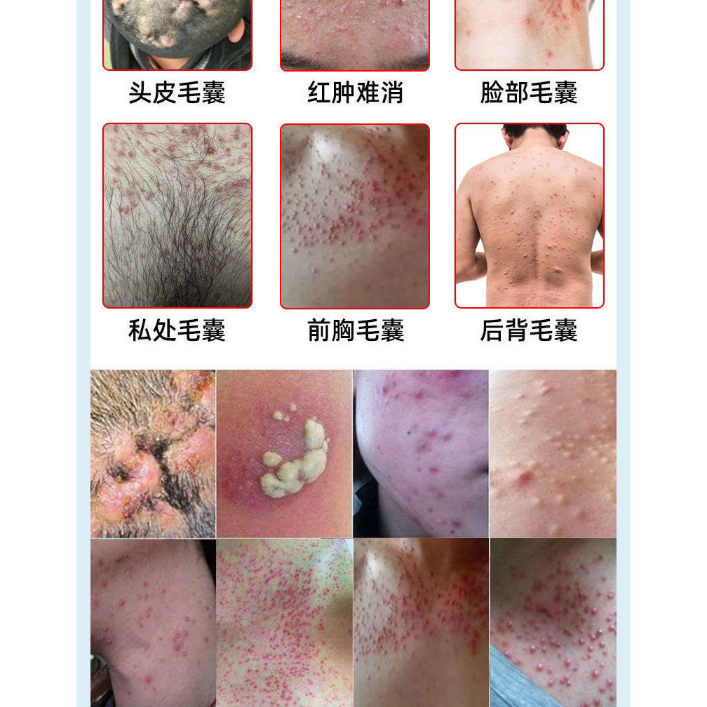 New Product#Folliculitis Ointment Special Effect Imported Head Face ...