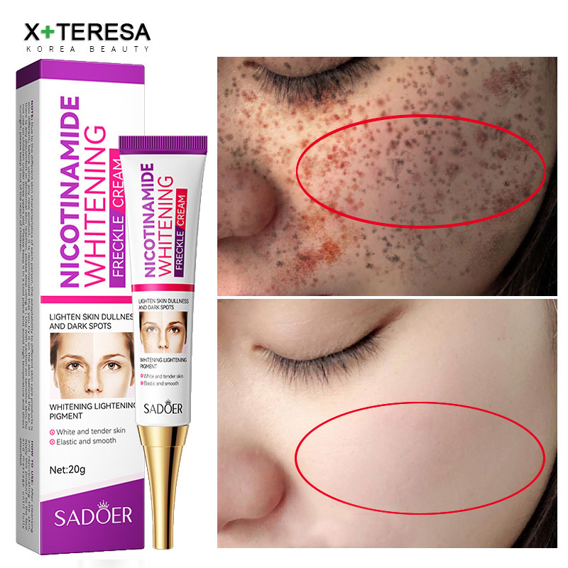 Freckle Cream Remove Melasma Dark Spots Whitening Melanin Corrector Treat Acne Scars Brighten ...