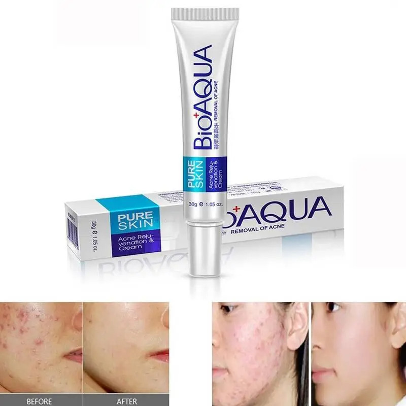 30g Anti Acne Treatment Whitening Skin Care Face Cream Anti Acne ...