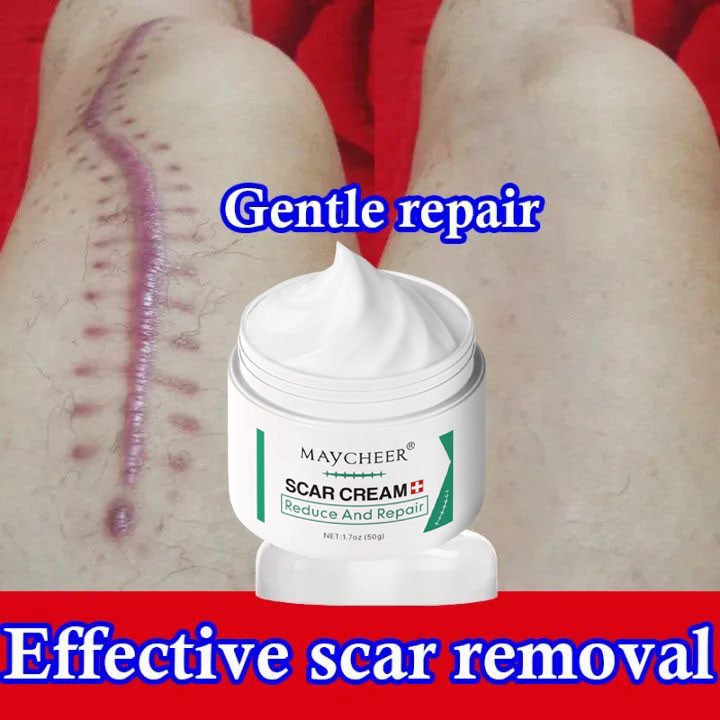 Scar Removal Cream 50g quickly specializes in removing long-term keloid ...