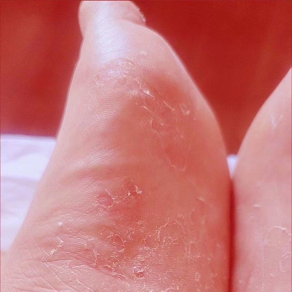 One spray of athlete's foot-free spray removes stinky feet, a spray ...