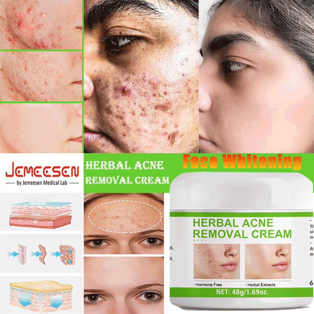 Jemeesen Acne Treatment Gel Fighting Breakouts Spots Cystic Acne Acne Scar Removal Cream Face ...