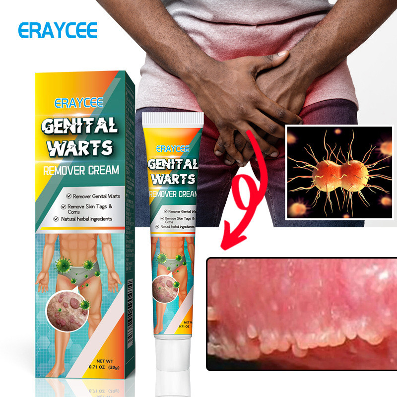 Herbal Men Women Private Part Wart Removal Agent Ke Wart Cream Pinghou ...