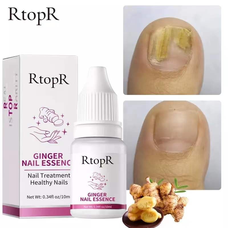 Nail Oil Serum Fungus Infection Damaged Finger nail Ginger ...
