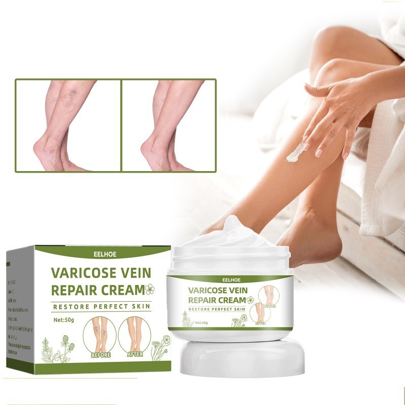 EELHOE Varicose Vein Cream Swelling Earthworm Leg Care Varicose Venous ...