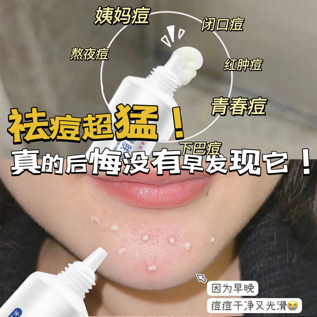 Bleaching skin whitening acne treatment acne Removal Cream Remove acne ...