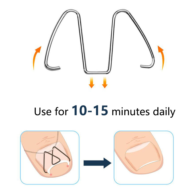 Piq302 Ingrown Toenail Correction Tool Ingrown Toe Nail Treatment Nail ...