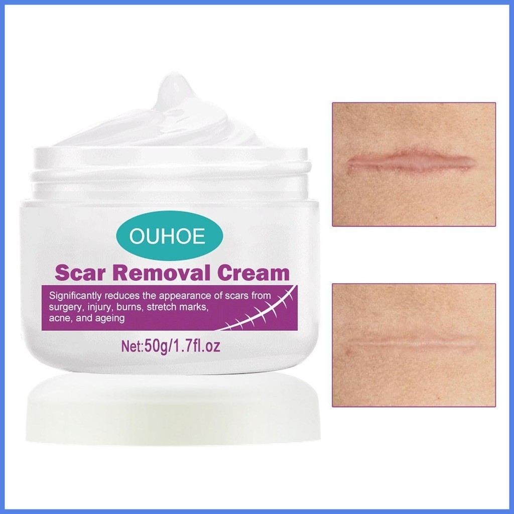 Stretch Mark Cream Burn Repair Balm for Face and Body Hydrating Scar ...