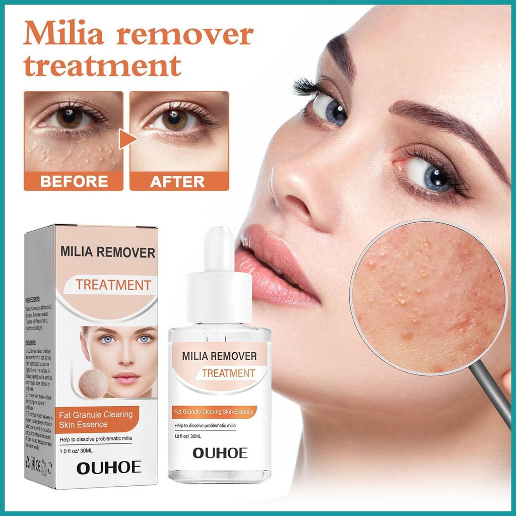 Milia Removal Tool 30ml Gentle and Safe Milia Remover for Fat Granule ...