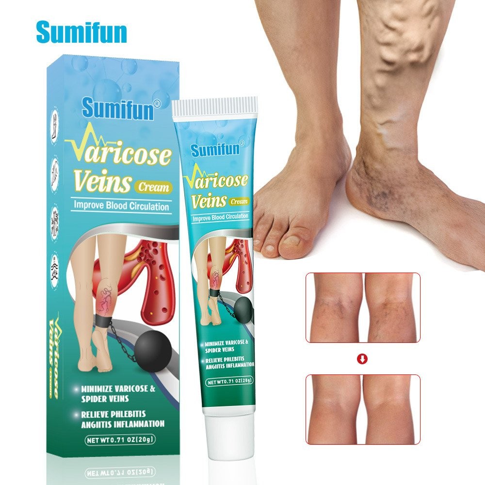 2pcs Varicose Veins Relief Cream Vasculitis Phlebitis Pain Relief ...