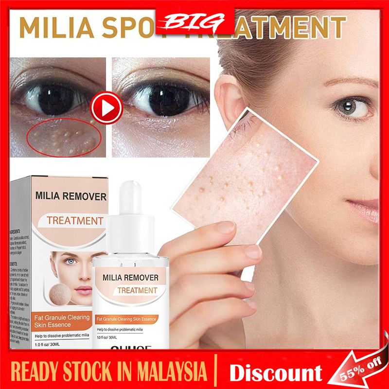 Original Serum Milia Remover Treatment Milia Seed Remover Ubat Milia ...