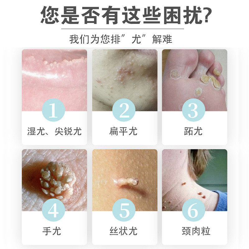 Lithospermum Wart Cream Herbal Gentle Plant Extract Remove Eyelets ...