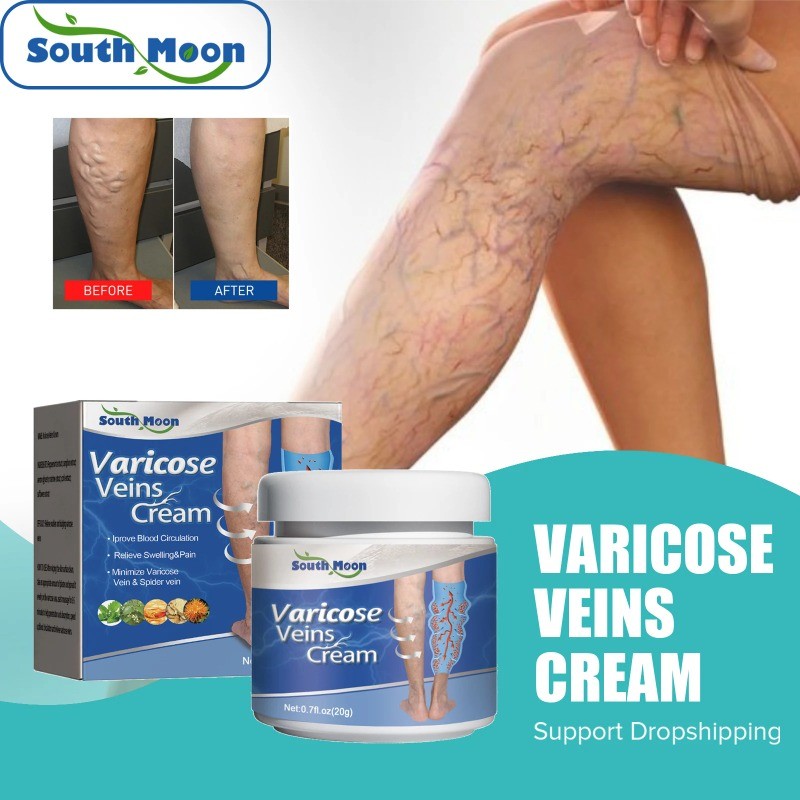 Varicose Veins Removal Cream Effective Treatment Vasculitis Earthworm ...