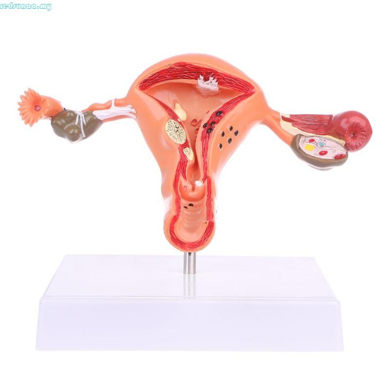 redsunaa Pathological Uterus Ovary Anatomical Model Anatomy for Cross ...
