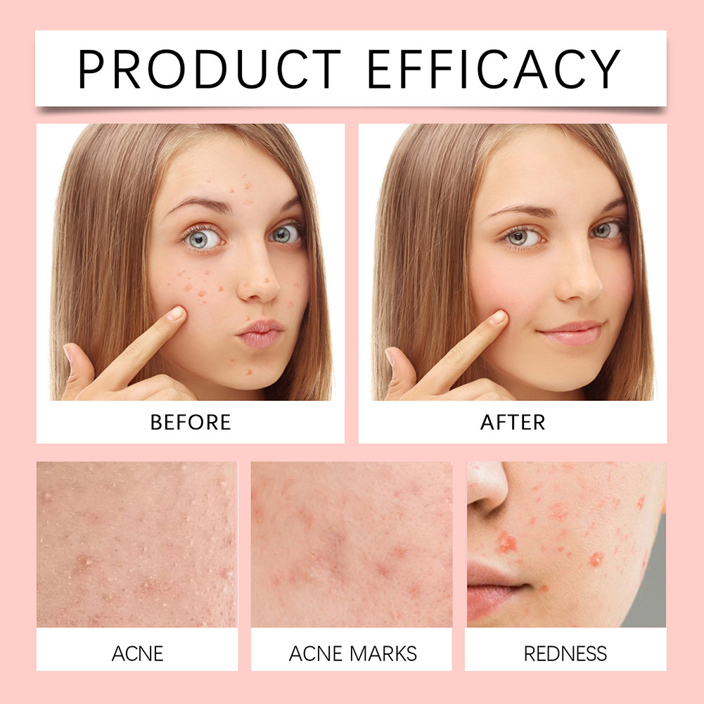 Acne Pimple Patch Acne Zit Patches Zit Stickers for Covering Zits and ...