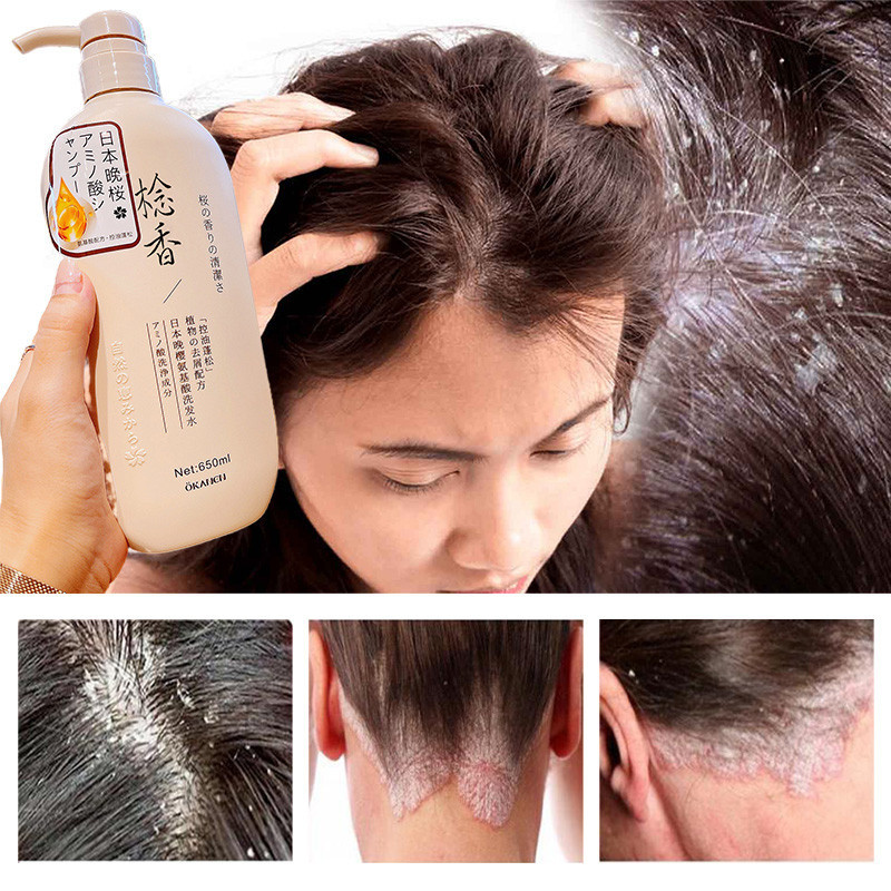 amino acid shampoo kelemumur scalp shampoo anti dandruff shampoo psoriasis shampoo ubat kutu ...