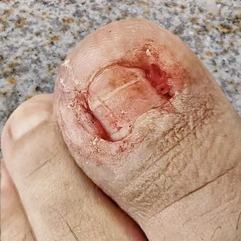 Toenail seam inflammation, swelling and pain, severe paronychia, foot ...