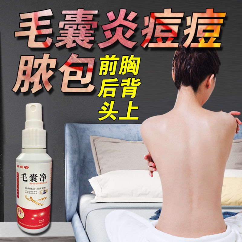Folliculitis Kex Special Spray Can Remove Scal Folliculitis Star ...