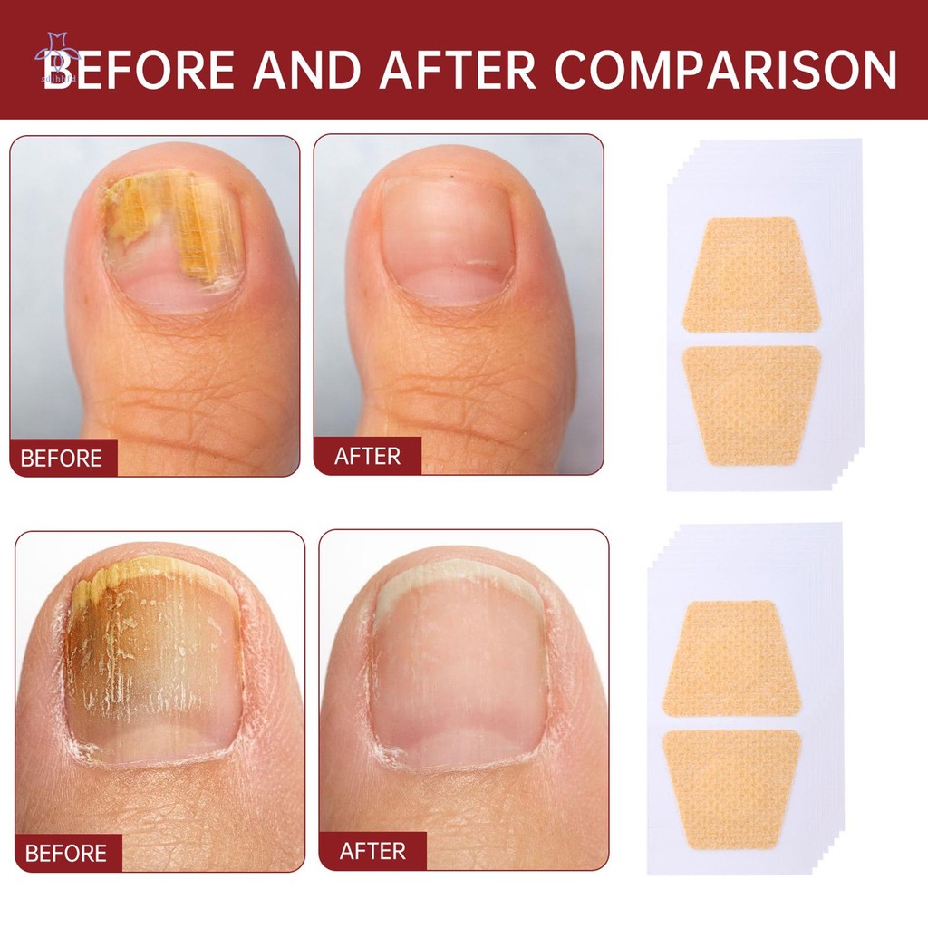 Yellow Toenail Patch for Fungi Nail Nighttime Renewal Fungal Nail ...