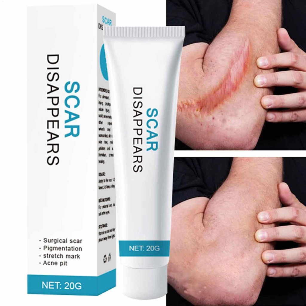 Body Burn Scar Cream 20g Skincare Tummy Scar Reducing Cream Skin Scar ...