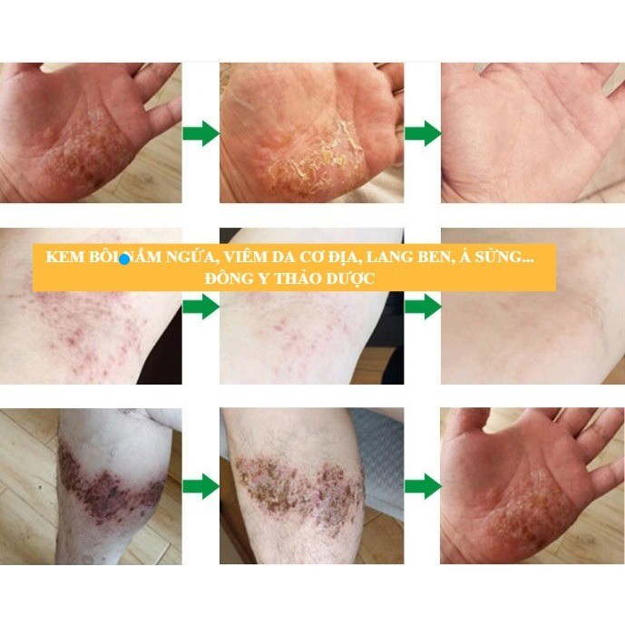 Anti-fungal Cream for Itchy Head, Scabies, Tinea versicolor, Keratosis ...
