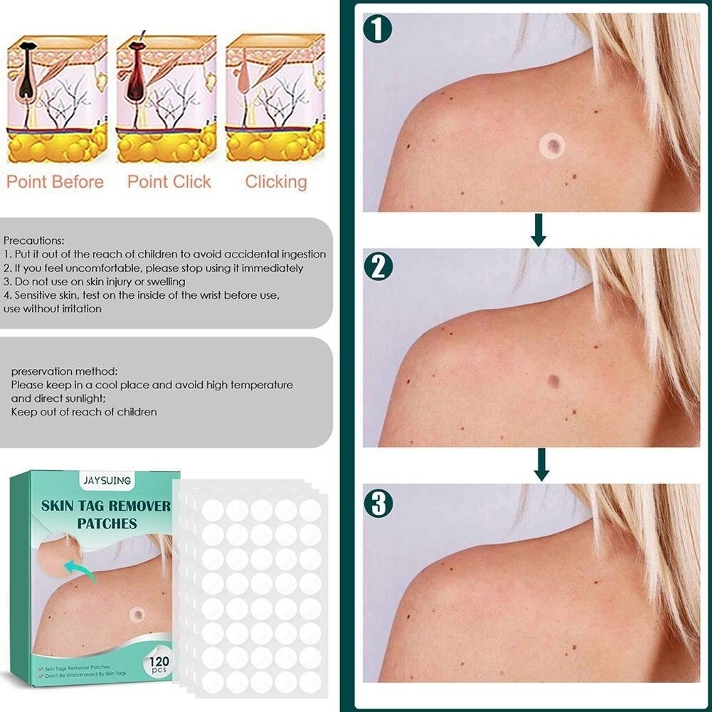 Corn wart remover Buang kutil Ketuat remover Plaster Ketuat Corn ...