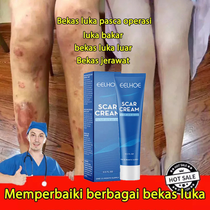 Scar Cream Light Mark Growth Repair Acne Marks Pits Bump Pimples Old ...