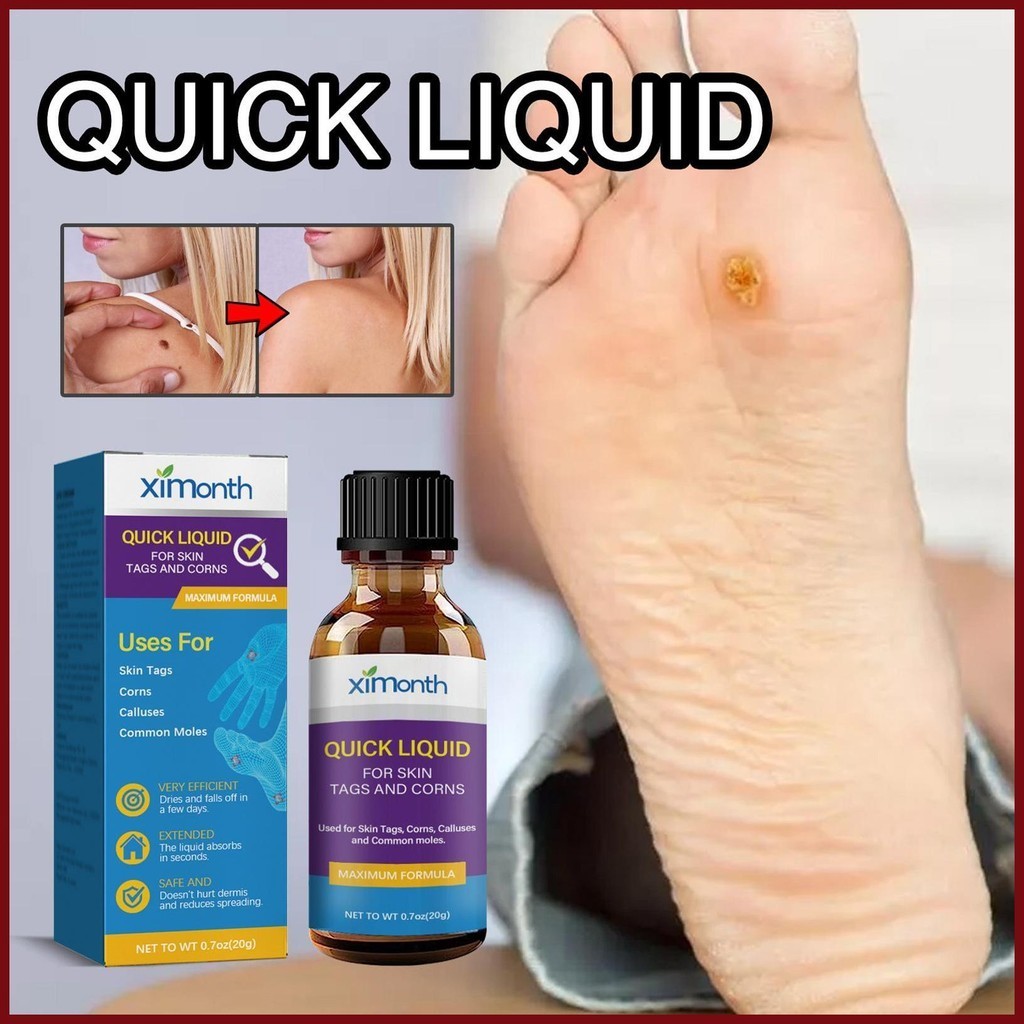 Skin Tag Remover 20ml Safe Natural Liquid Wart Skin Tag Cleanser ...