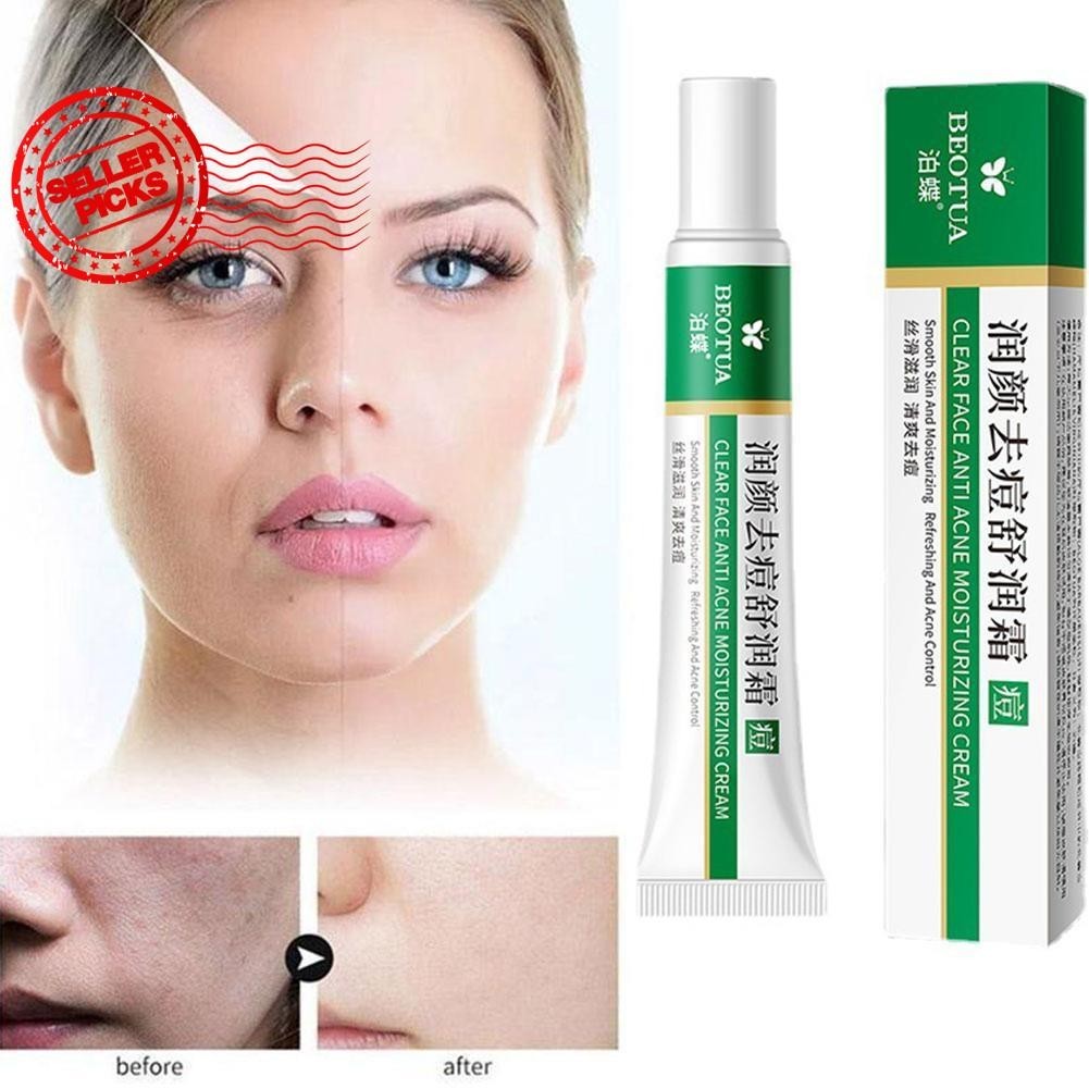 Effective Acne Removal Cream Acne Treatment Anti Acne Care Whitening Control Shrink Refreshing ...