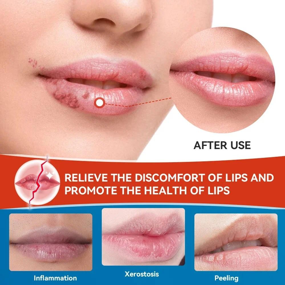 Cheilitis Cream Treat Inflammation Labial Herpes Antibacterial Ointment ...