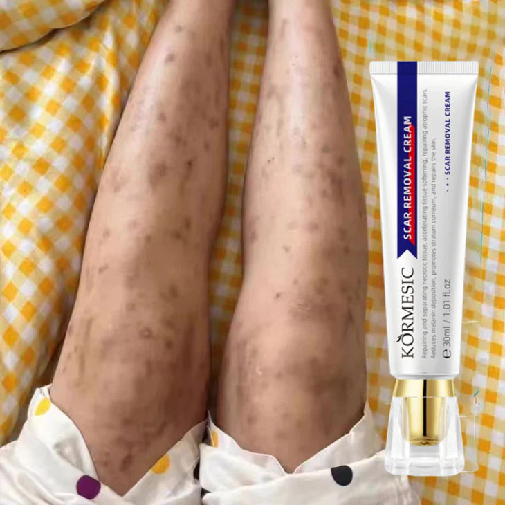 Dark removal cream, old scar removal, leg scars, insect bite scars ...
