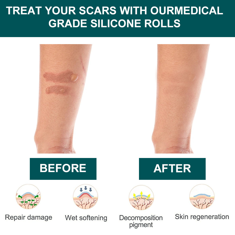 3M Silicone Scar Sheets Effective Keloid Removal Strip for C-Section ...