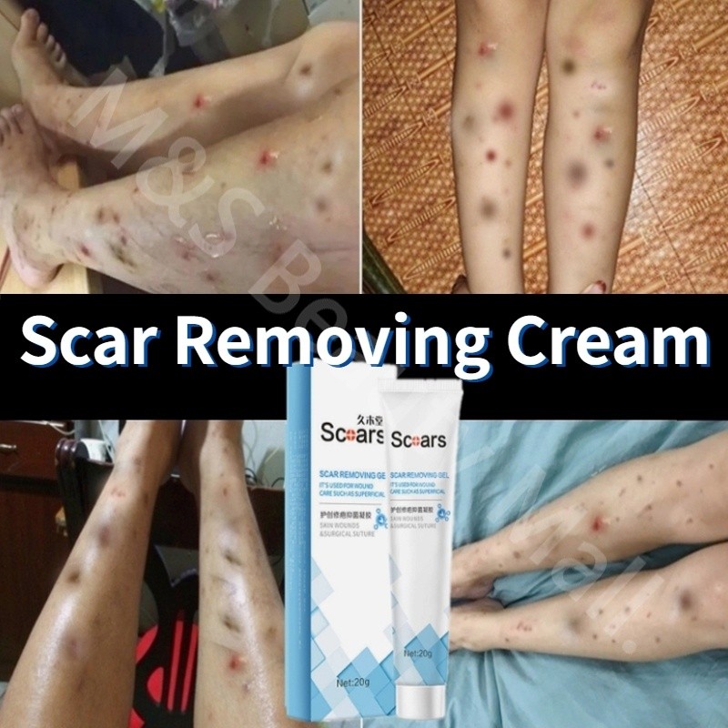 Scar removal cream 20g repair bid farewell to dark melanin scar ...