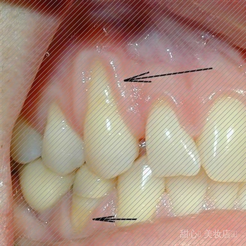 Toothpaste probiotic severe gum atrophy tooth root leakage odontoseisis ...