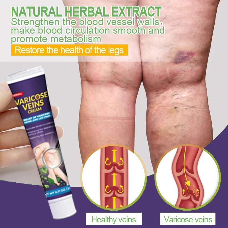Varicose Vein Relieve Cream Herbal Ointment For Varicocele To Relieve ...