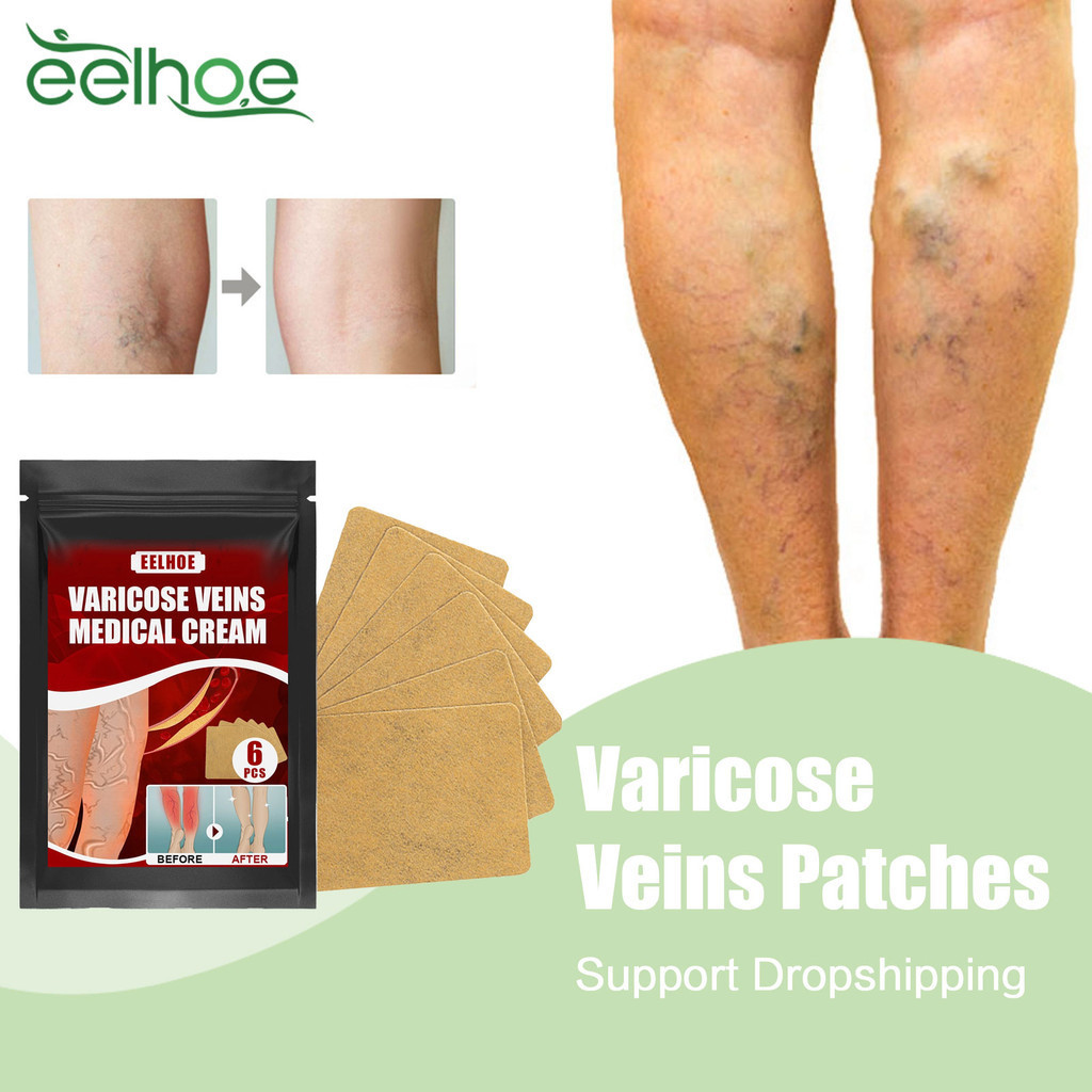 Varicose Vein Treatment Patch Treat Spider Leg Edema Nerve Pain Blocked ...