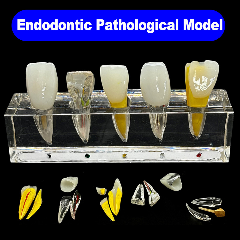 Dental Model Endodontic Pathological Model Anterior Front Labial ...